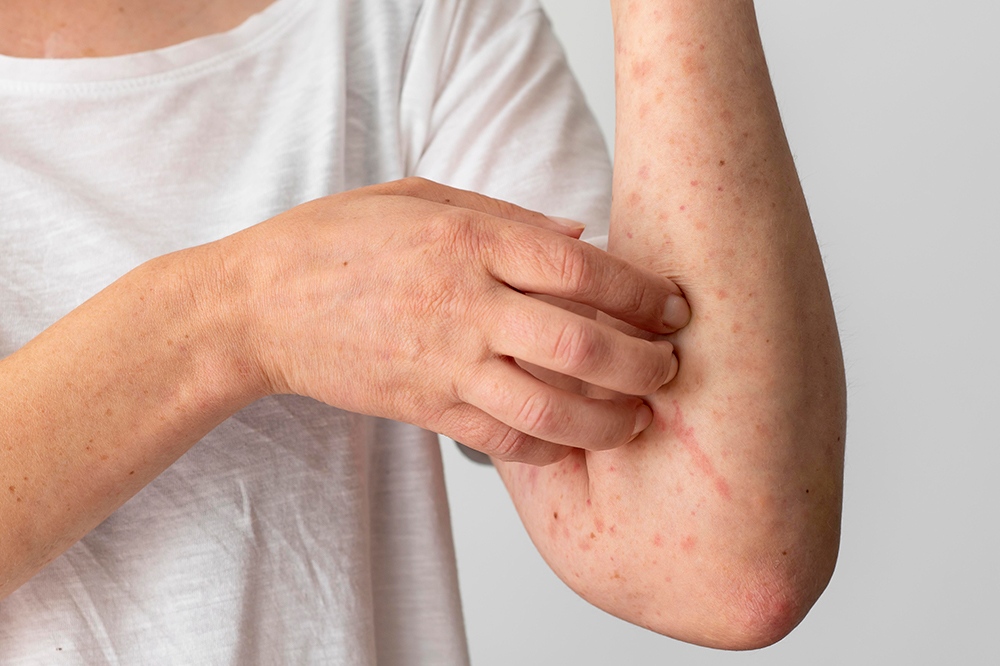 Ministry of Health increases surveillance for Monkey pox