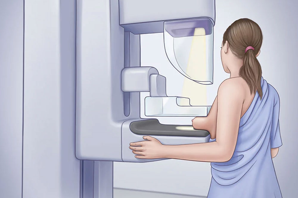 Breast Cancer Screening